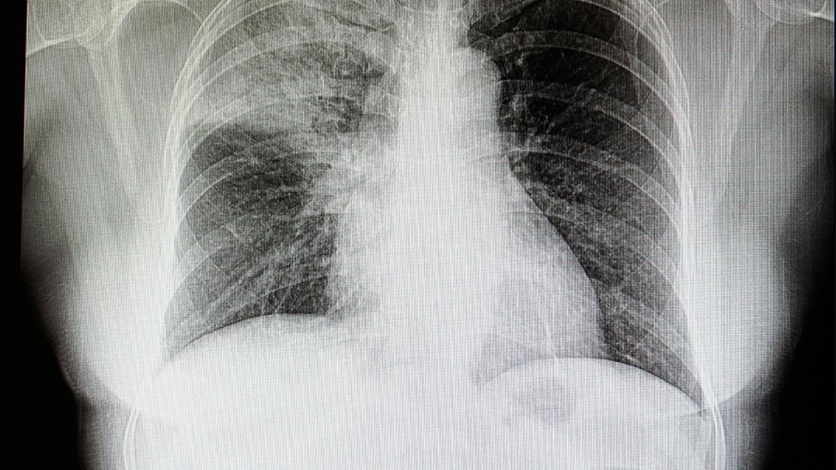 La radiographie de thorax pour le diagnostic de pneumonie aiguë ...