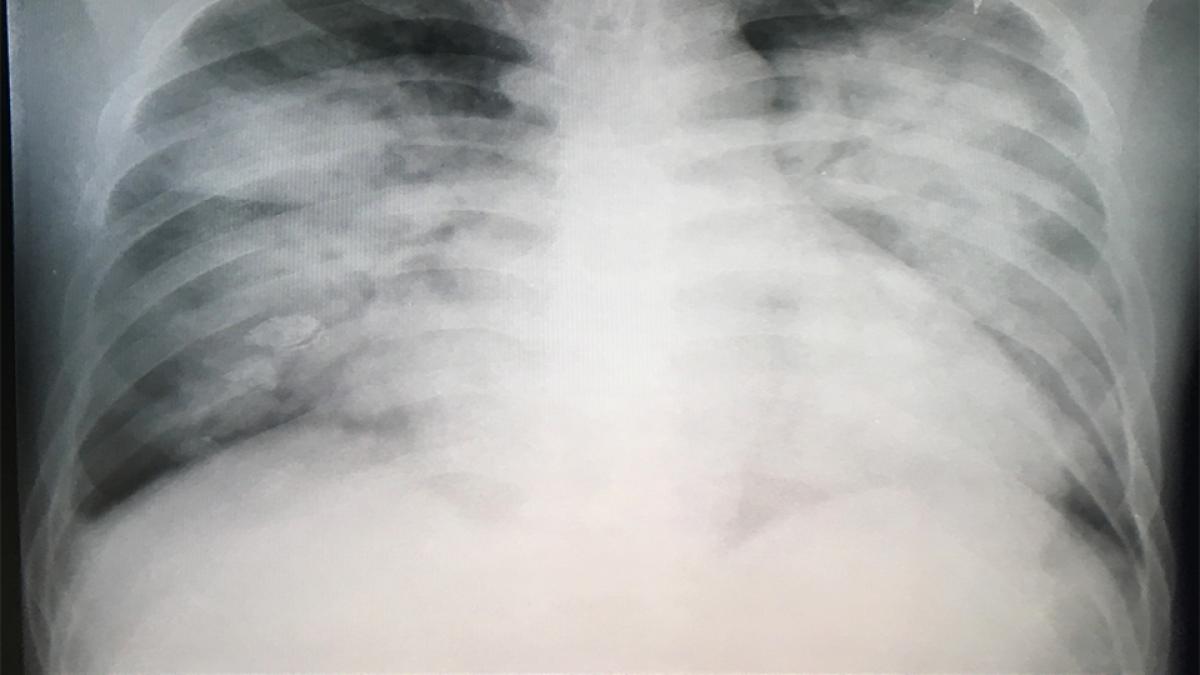 Sédation et curares au cours du SDRA : juste ce qu’il faut… | SRLF