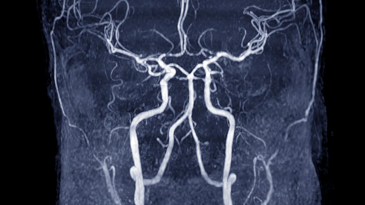 Occlusion aiguë de l’artère basilaire : la thrombectomie est-elle ...