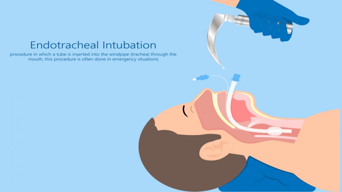 Comment éviter les complications de l’intubation en réanimation ? | SRLF