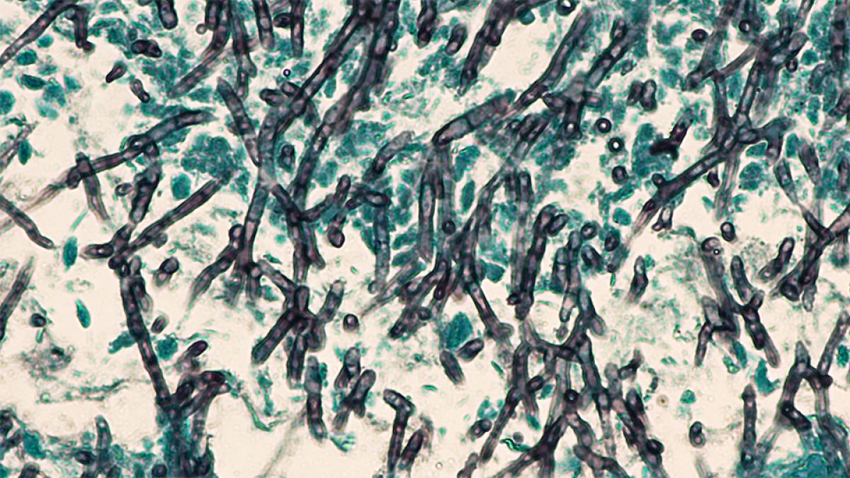 PAVM et aspergillose pulmonaire invasive : Les deux faces d’une même ...