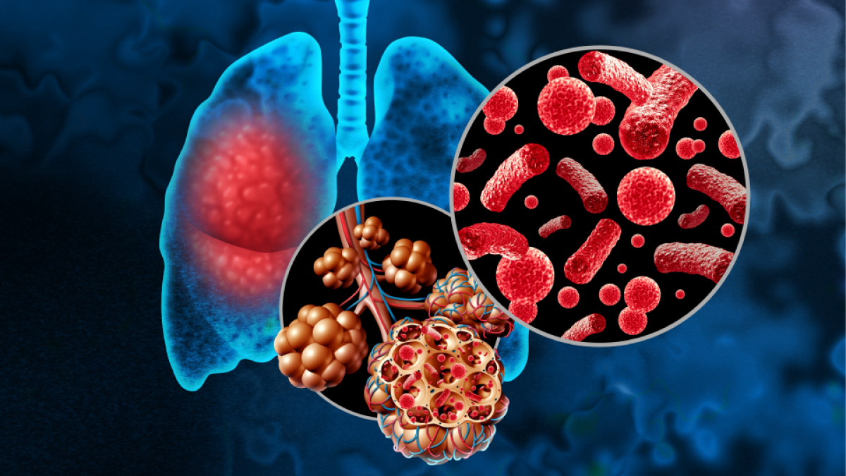 Corticoïdes et pneumopathies : Game over ? | SRLF